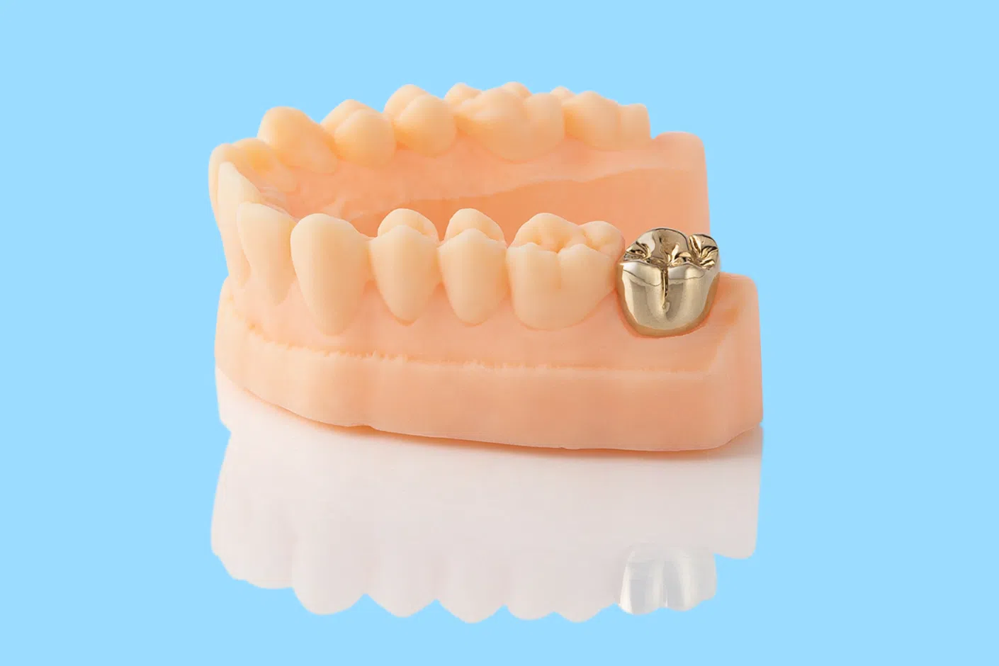 Metal Crowns Dental Products | Avant Dental